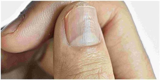 Understanding the Real Causes of Vertical Ridges on Your Nails - Dr ...