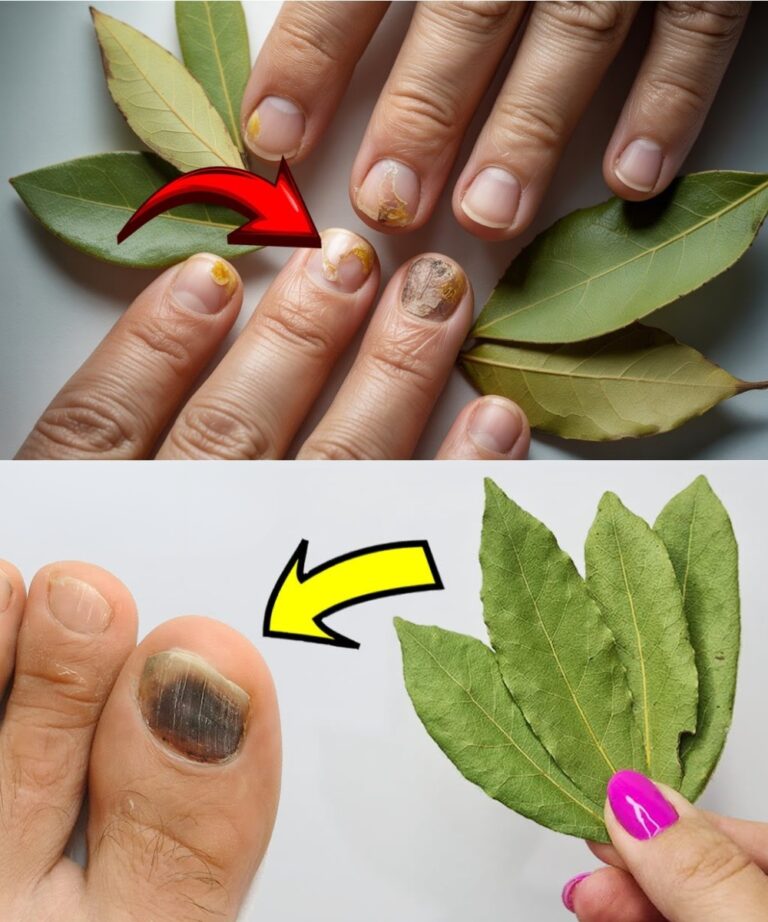 Bay Leaf Remedy for Nail Fungus A Natural Solution Under $1 - Dr ...
